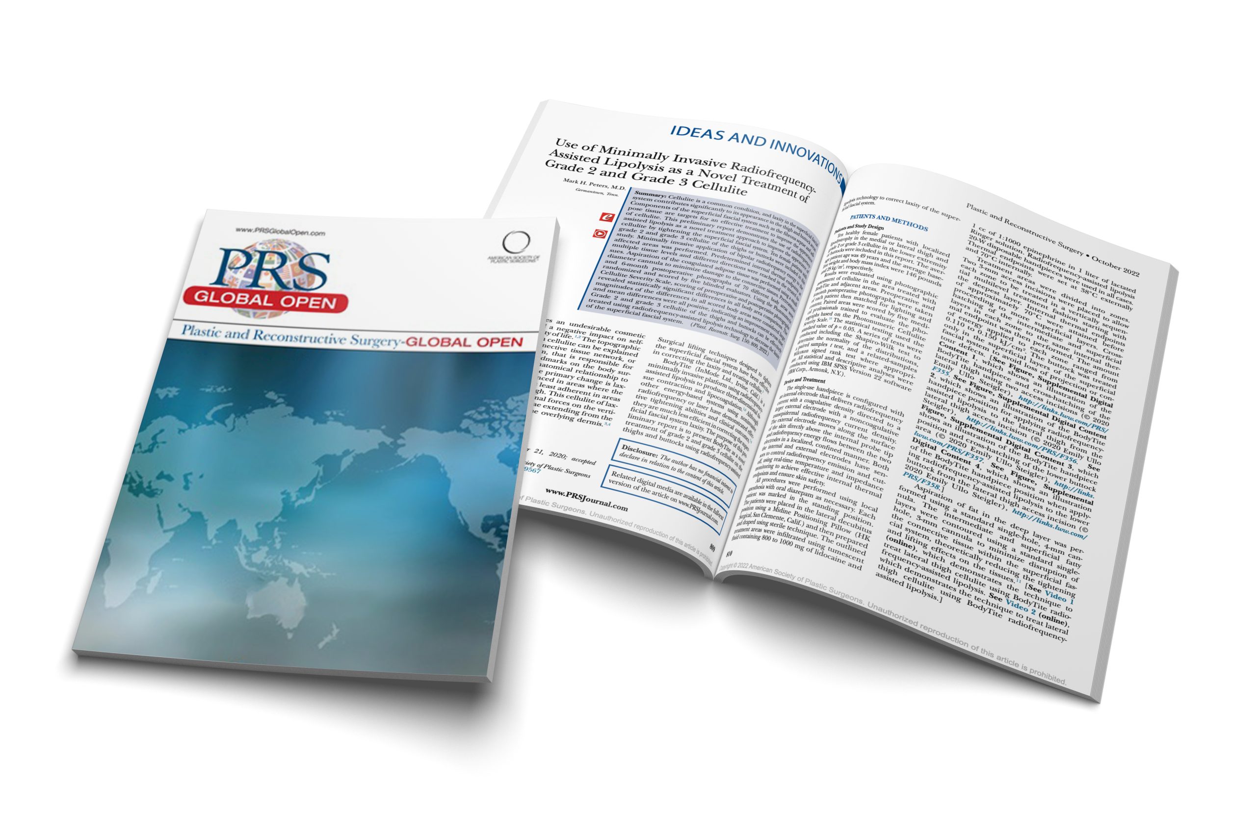 Use of Minimally Invasive Radiofrequency-Assisted Lipolysis as a Novel ...